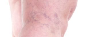 Reticular Veins - The New Jersey Vein & Vascular Center