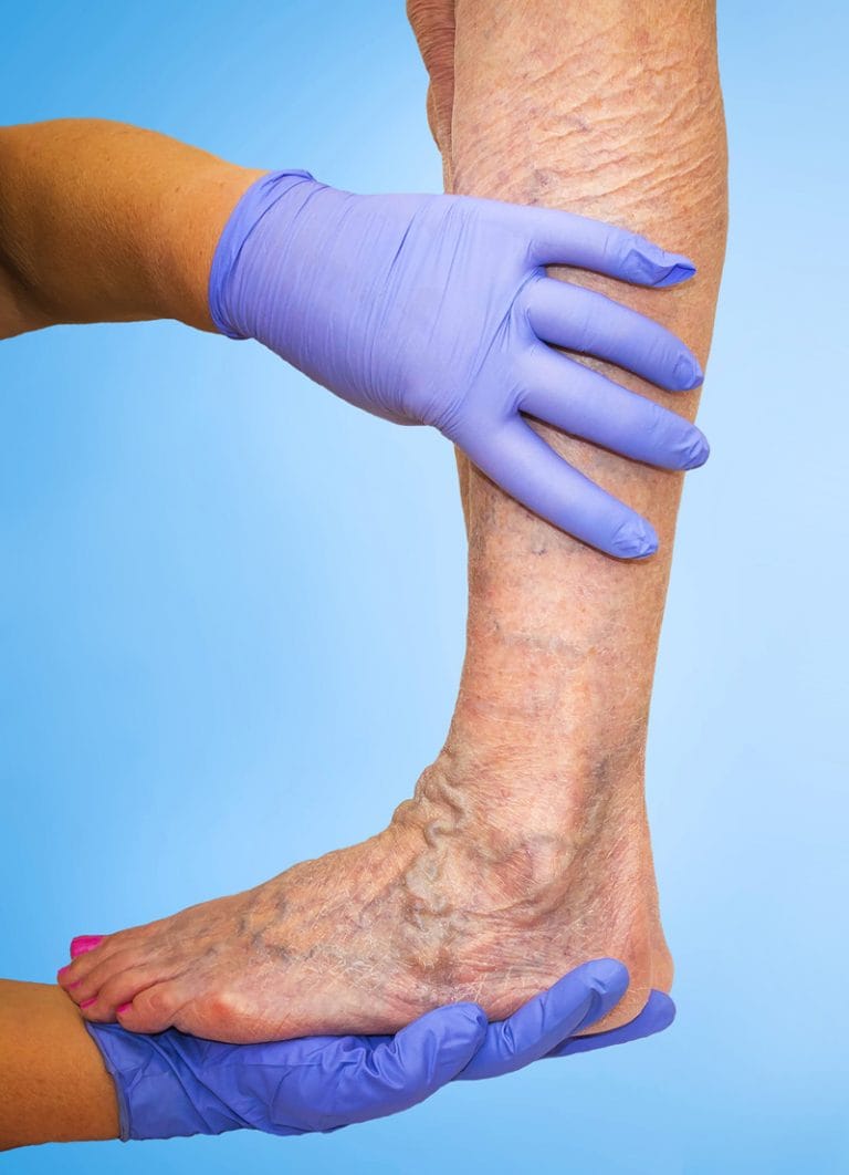 Venous Insufficiency and When to See a Vascular Specialist - NJVVC