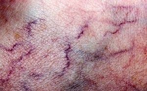 Venous Insufficiency and When to See a Vascular Specialist - NJVVC
