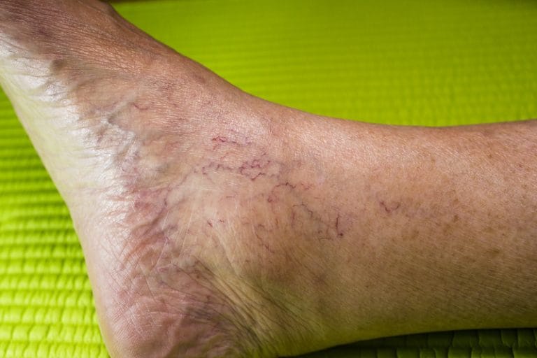 Everything You Need to Know About DVTs - Signs, Symptoms,Treatment