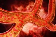 Everything You Need To Know About DVTs Signs Symptoms Treatment