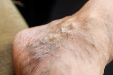 What You Need to Know About Venous Ulcers - NJVVC