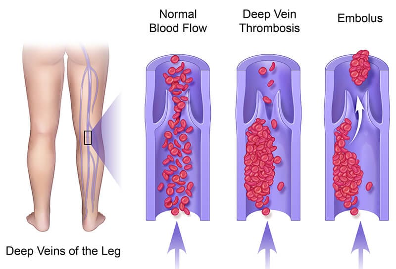 Full Guide On Understanding And Preventing Leg Blood Clots DVT 