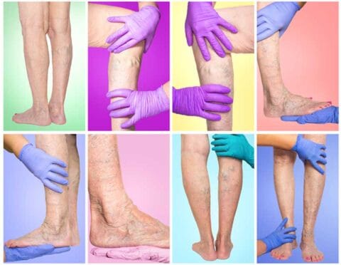 Everything About CVI Explained - The New Jersey Vein & Vascular Center