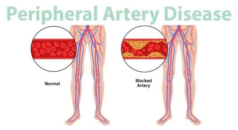 Poor Circulation in the Legs and Feet – What you Should Know